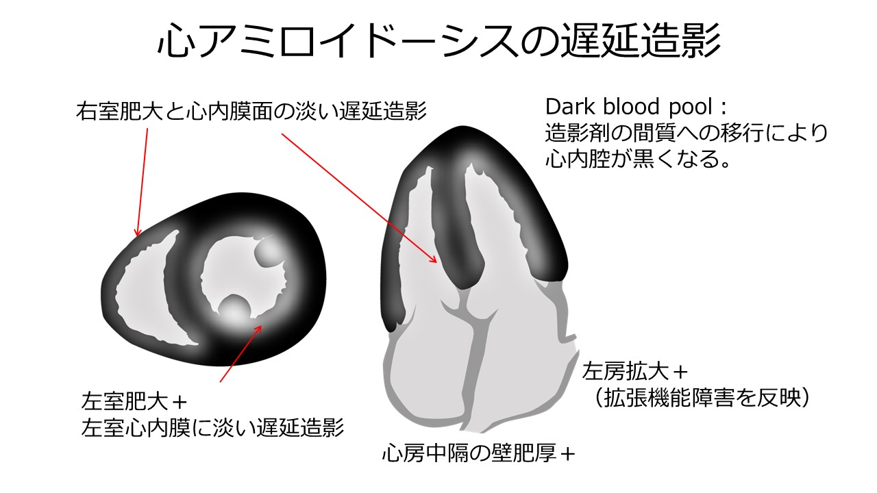 心アミロイドーシスのMRI - 循環器画像診断まとめ