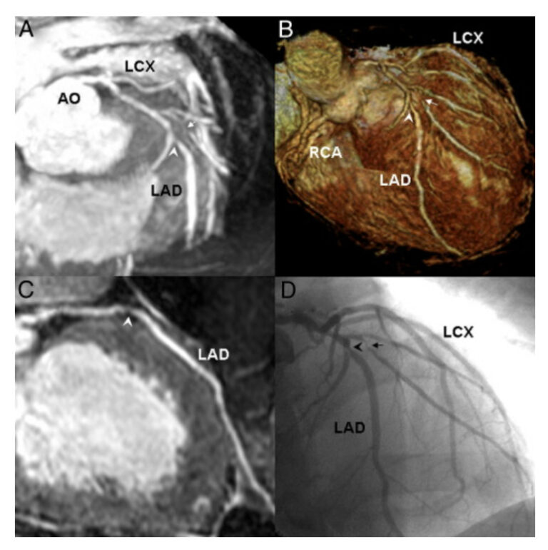 冠動脈MRA CTとの違い - 循環器画像診断まとめ